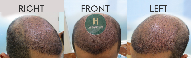 Hair Transplant Case Study with 4351 Grafts using scalp and Beard in 32 ...